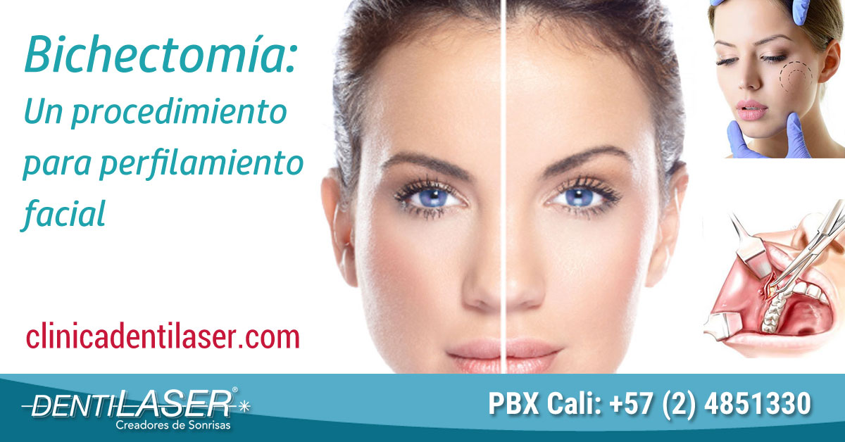 Bichectomía, en qué consiste este procedimiento - Clínica Dentiláser