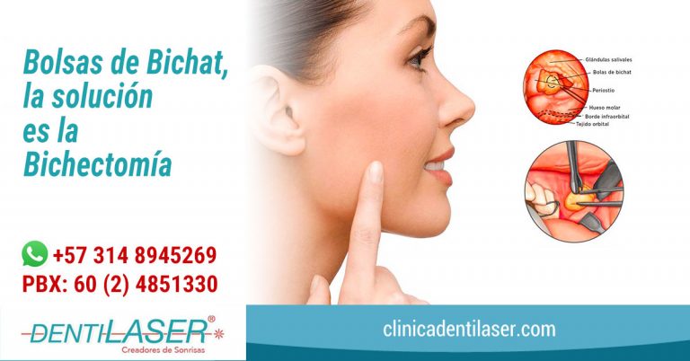 Bolsas de Bichat, la solución es la Bichectomía - Clínica Dentiláser
